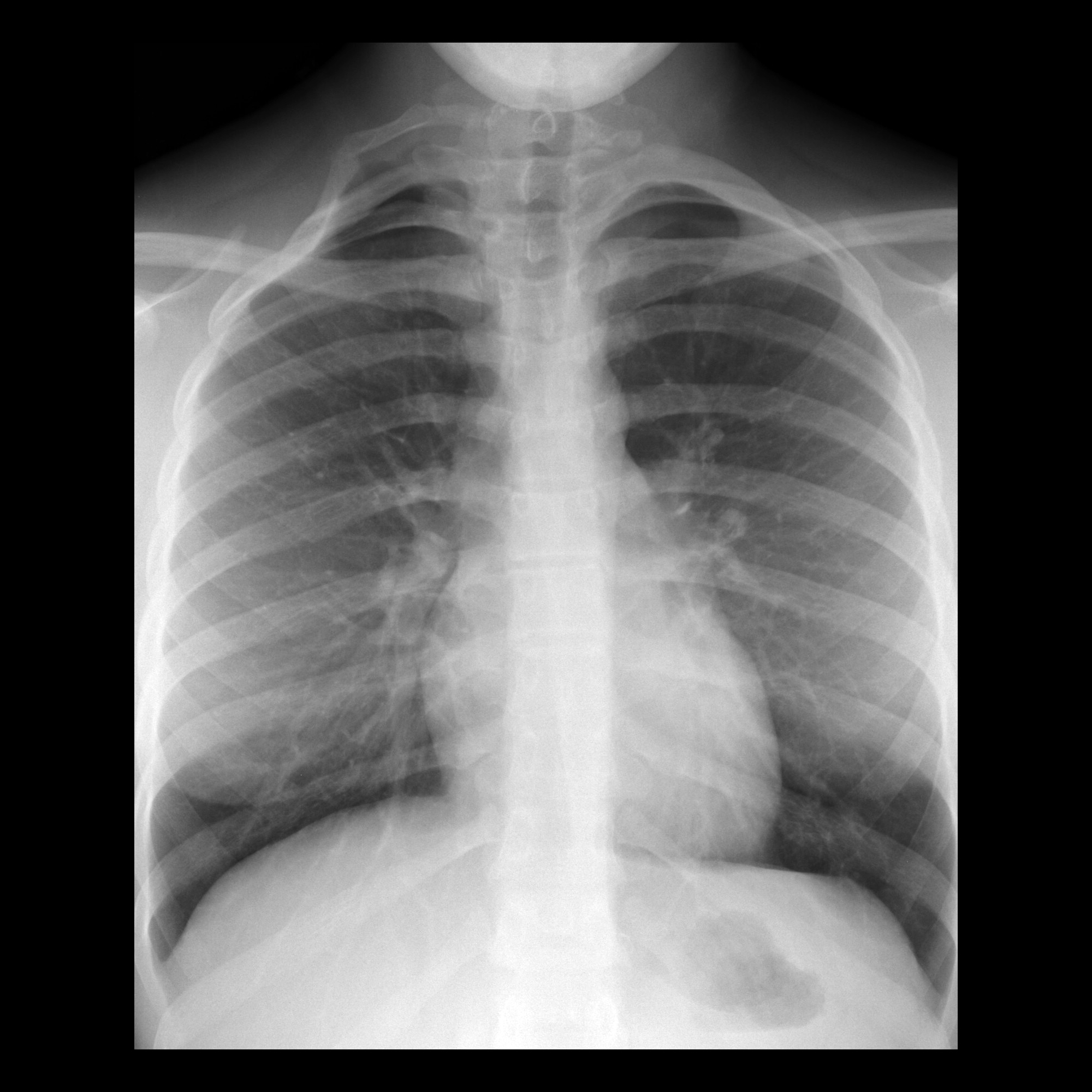 Pediatric Cervical Rib | Pediatric Radiology Reference Article ...