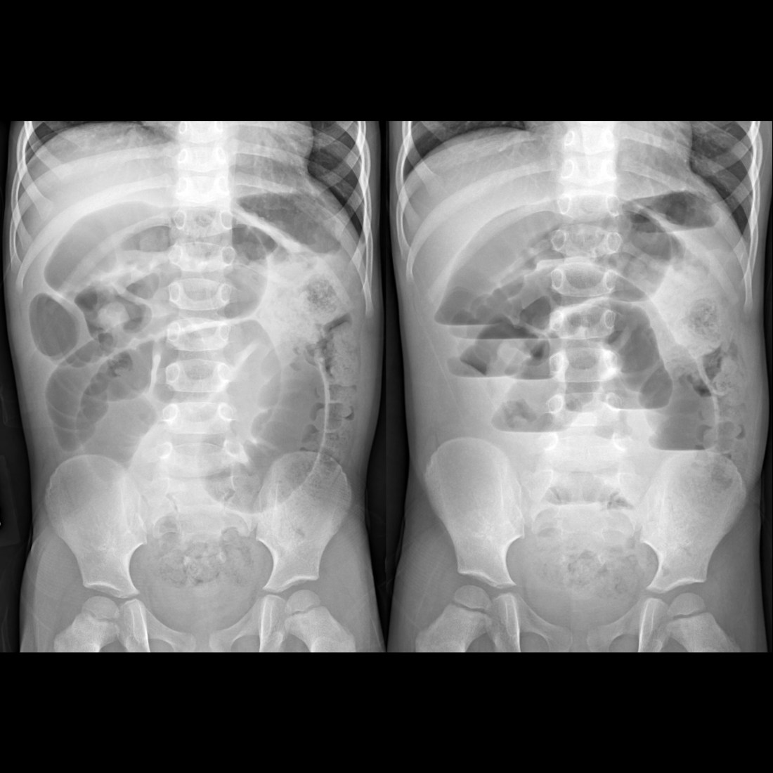 Pediatric Small Bowel Obstruction | Pediatric Radiology Reference ...