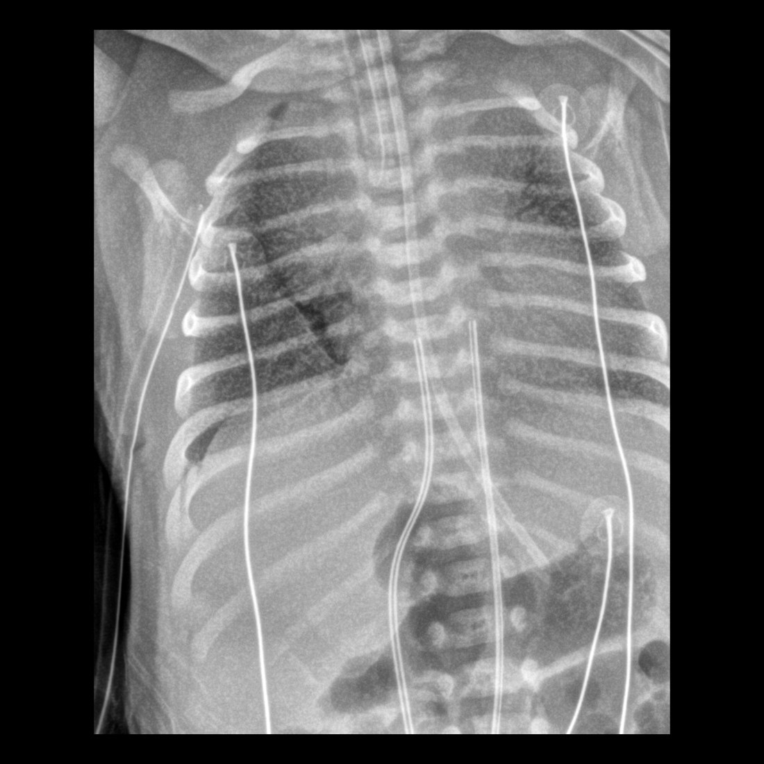 Pediatric Chest Tube Malfunction / Malposition / Misposition ...