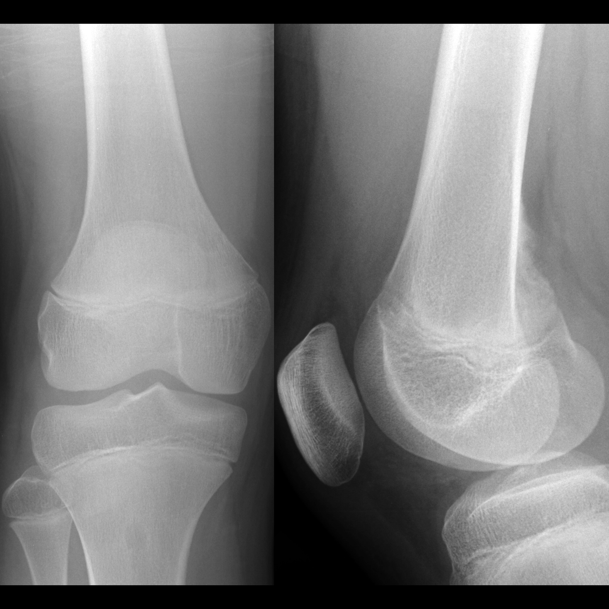 CorticalDesmoid01MDRightKneePainCorticalIrregularityMedialPosteriorAspectFemurPln12yo ...