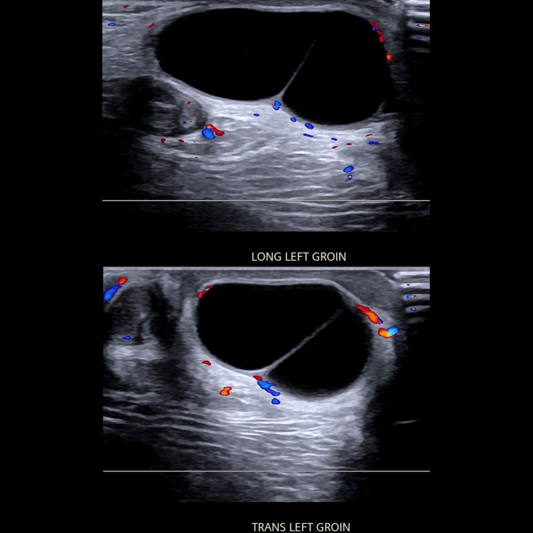 Hydrocele of Spermatic Cord | Pediatric Radiology Reference Article ...