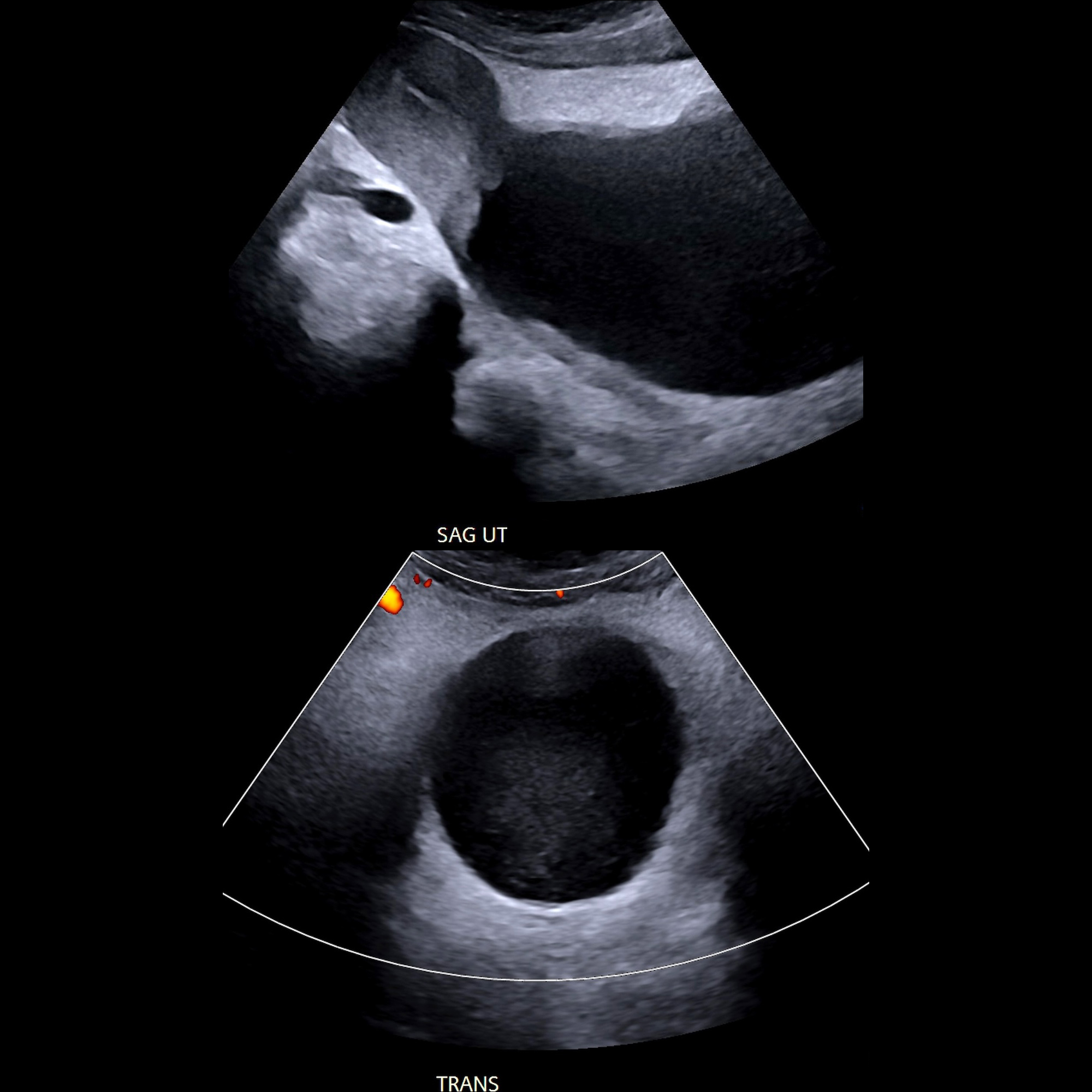 Hydrometrocolpos | Pediatric Radiology Reference Article | Pediatric ...