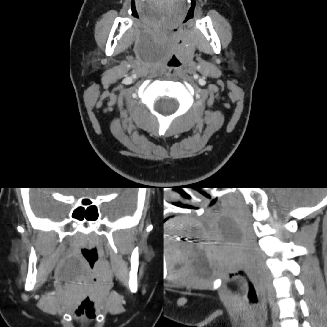 Pediatric Intratonsillar Abscess | Pediatric Radiology Reference ...