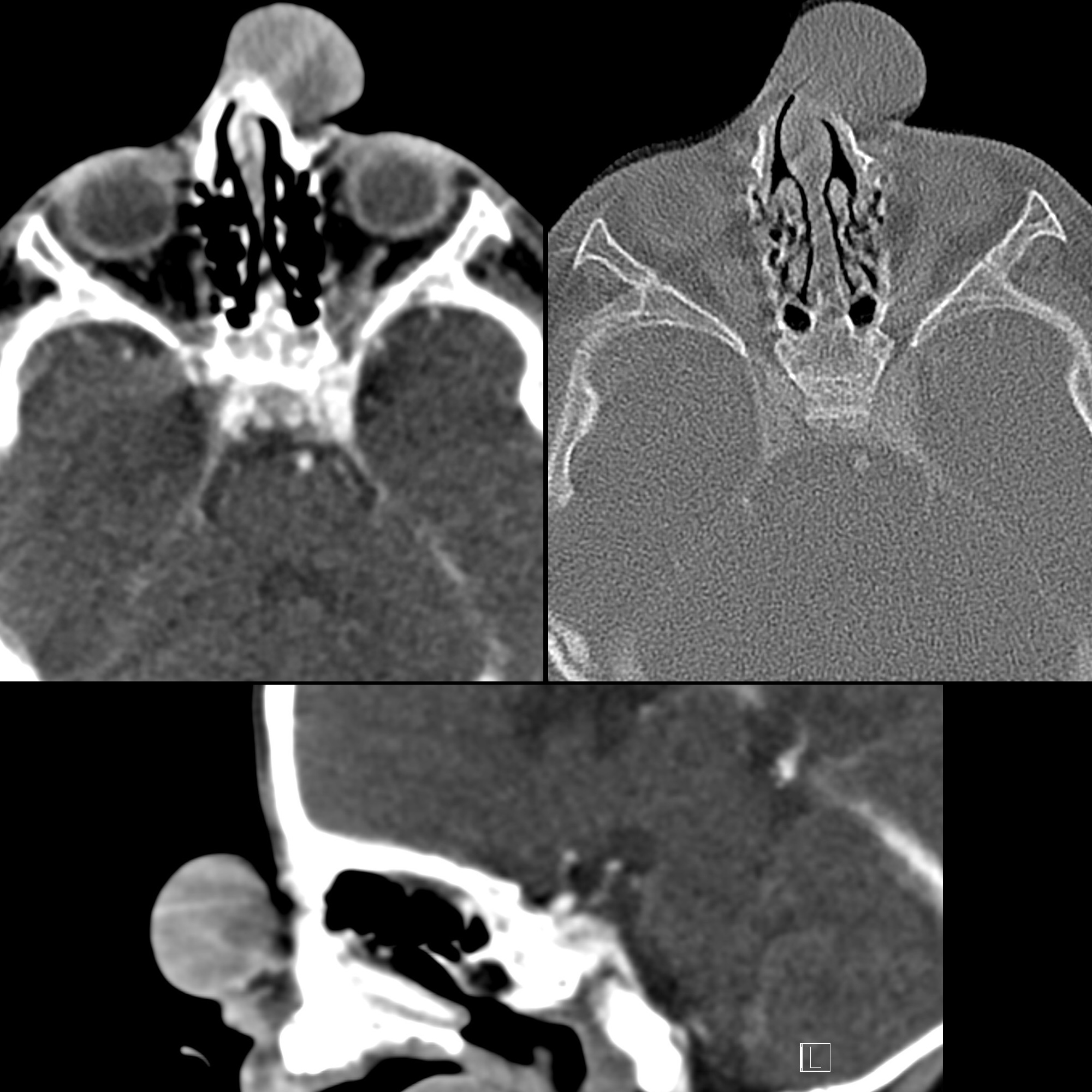 Pediatric Nasal Glioma | Pediatric Radiology Reference Article ...