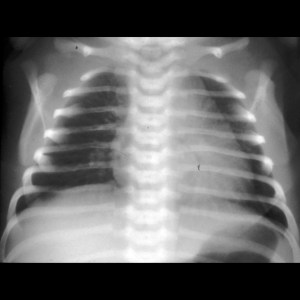 Pediatric Normal Chest | Pediatric Radiology Reference Article ...