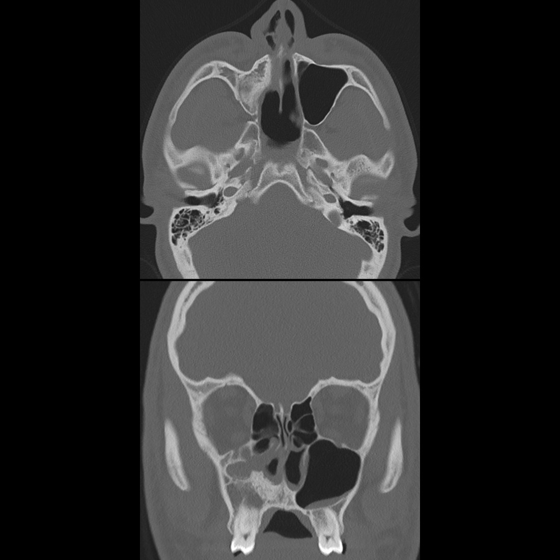 Pediatric Silent Sinus Syndrome | Pediatric Radiology Reference Article ...