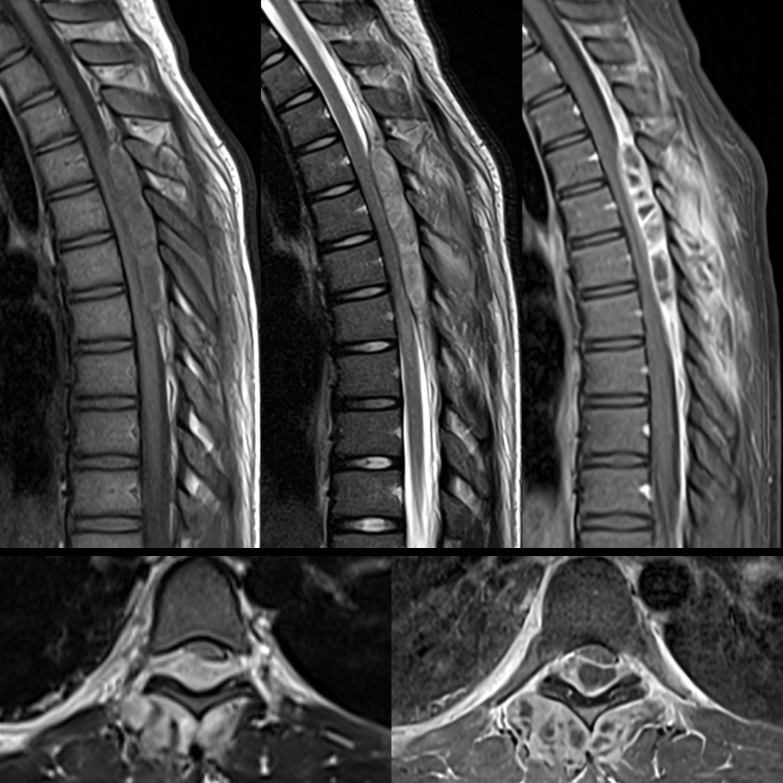 Pediatric Spinal Epidural Abscess | Pediatric Radiology Reference ...