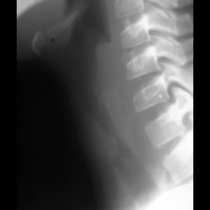 Bacterial Tracheitis | Pediatric Radiology Reference Article ...