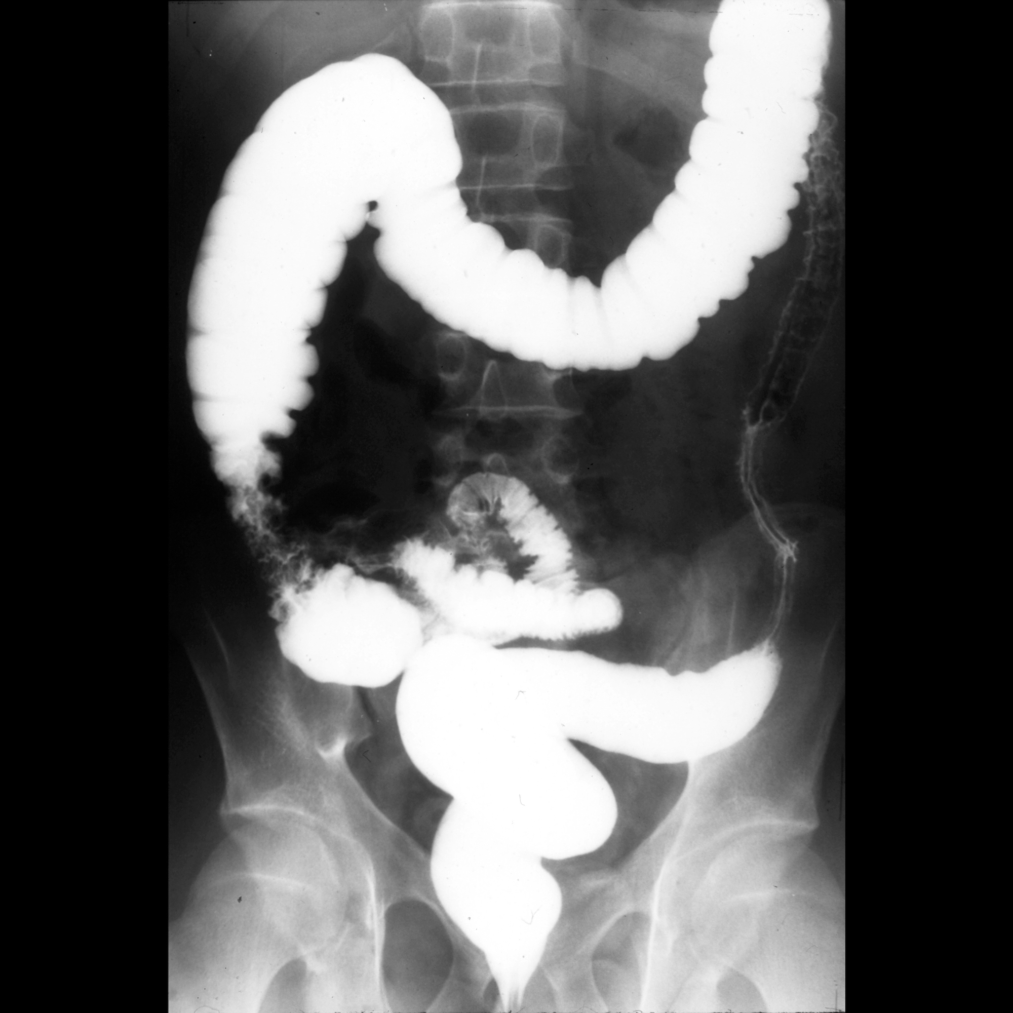 Pediatric Ulcerative Colitis | Pediatric Radiology Reference Article ...