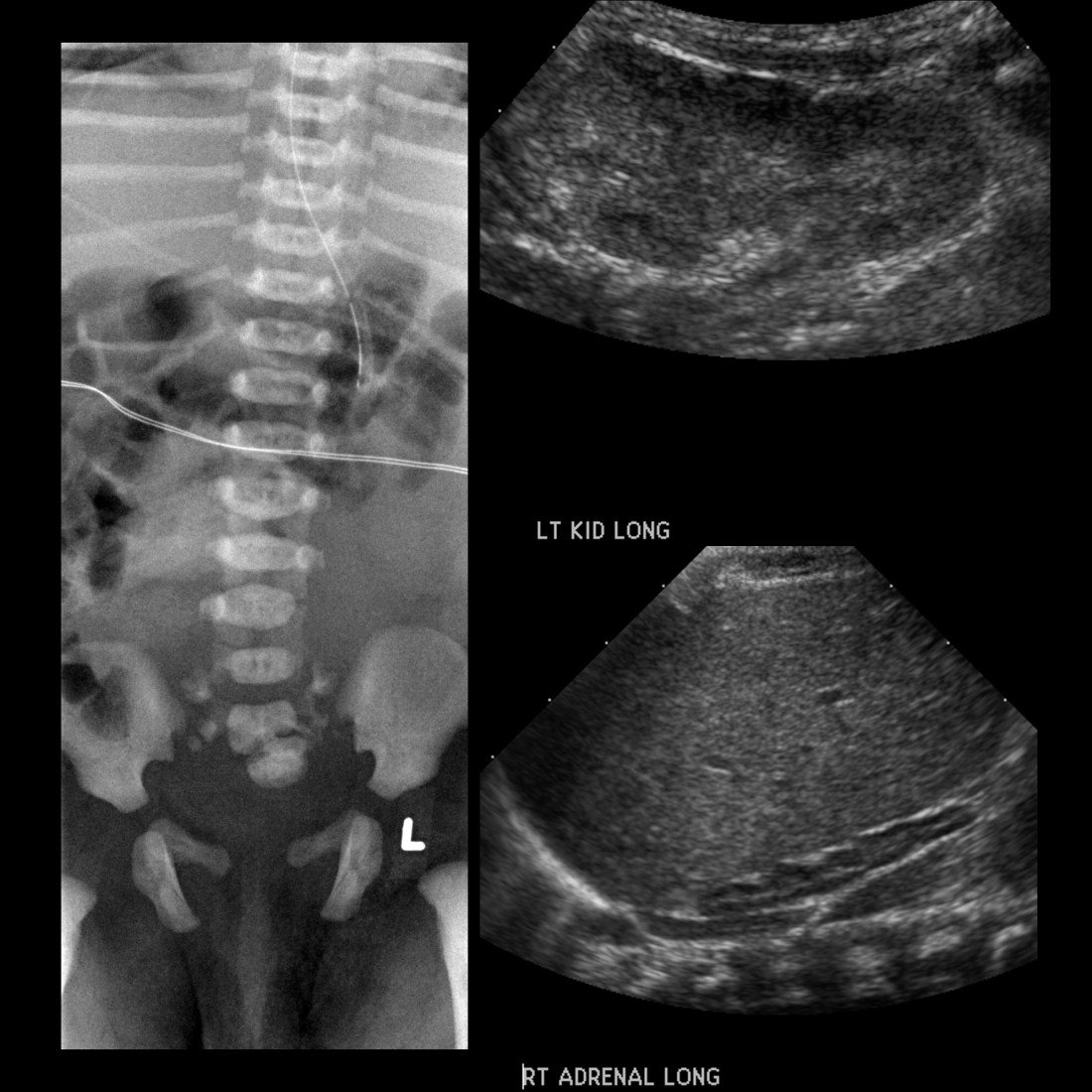 Pediatric Vertebral Body Anomalies | Pediatric Radiology Reference ...