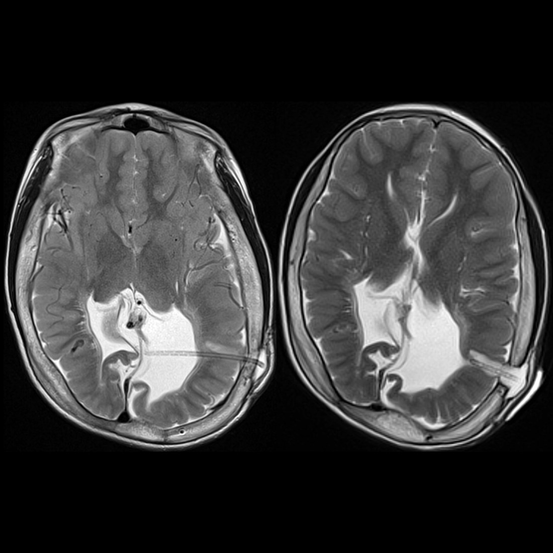 Pediatric Ventriculoperitoneal Shunt Malfunction / Malposition ...