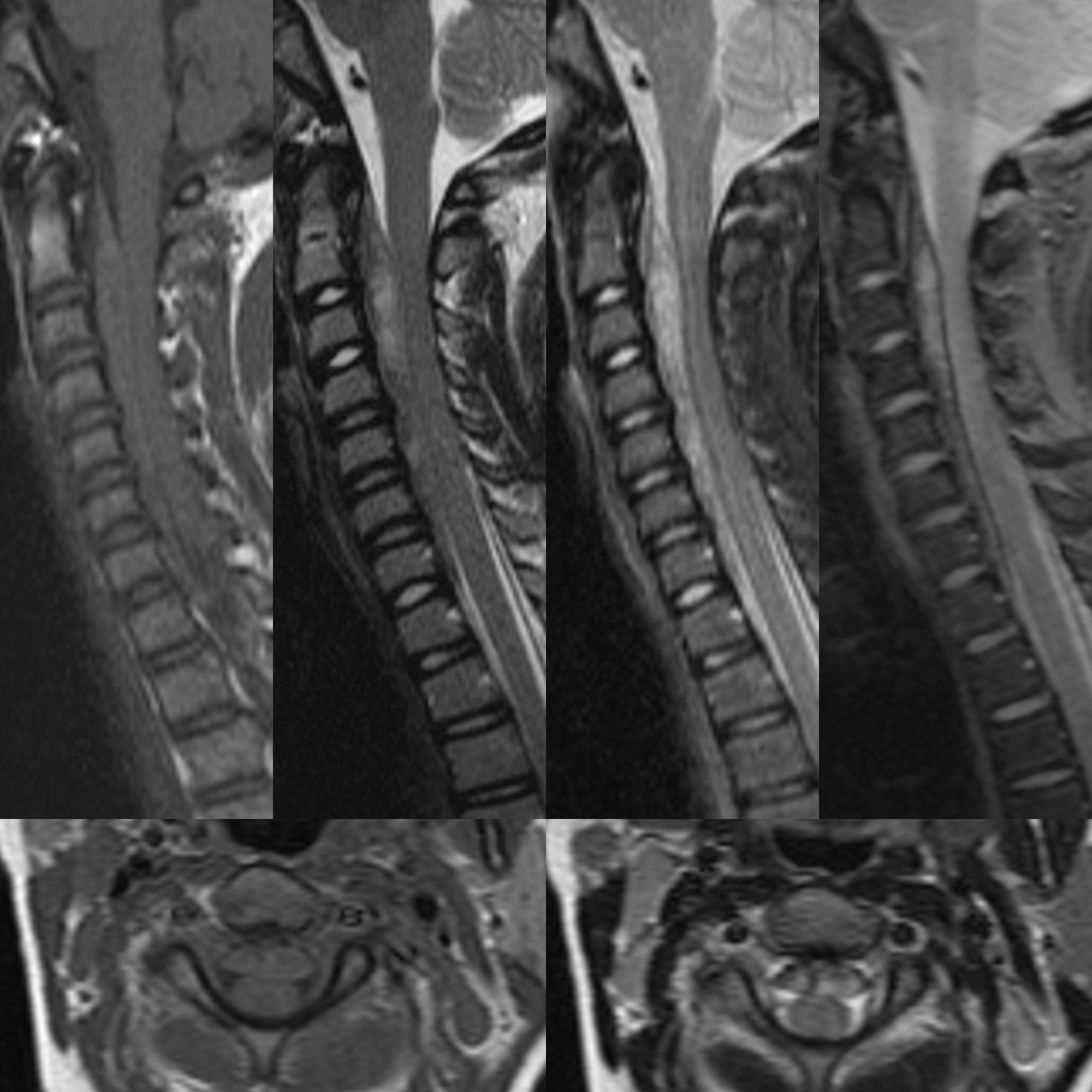 School ager with Factor 9 deficiency who has neck pain after being hit ...