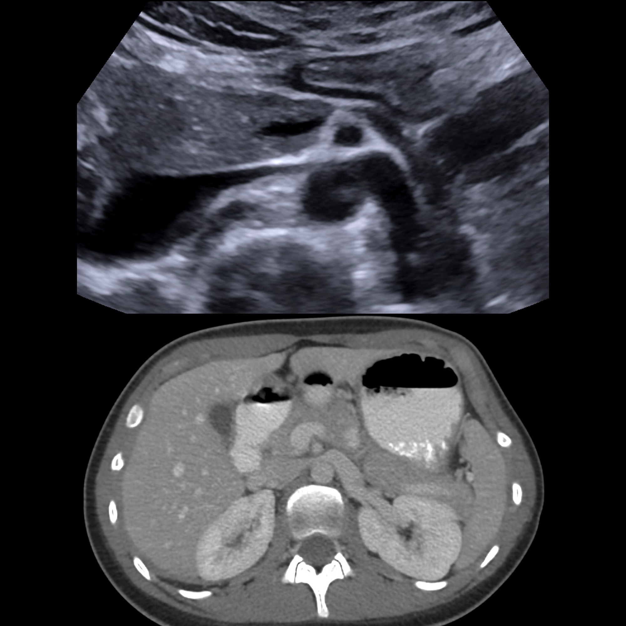 NutcrackerSyndrome01MDAbdominalPainHematuriaCompressionOfLeftRenalVeinW ...