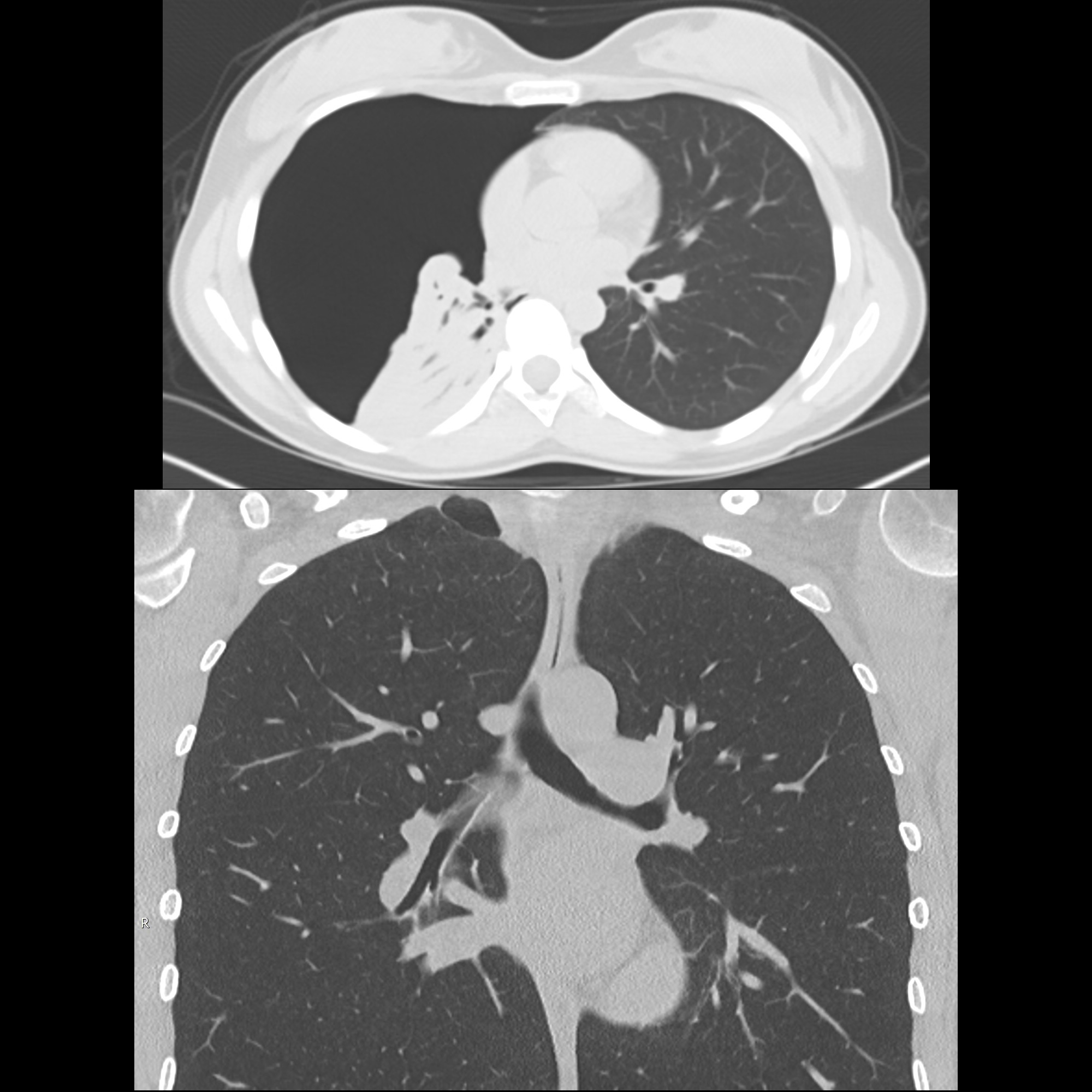 PneumothoraxSpontaneous02MDRightChestPainDueToApicalBlebsCTAtPresentati ...