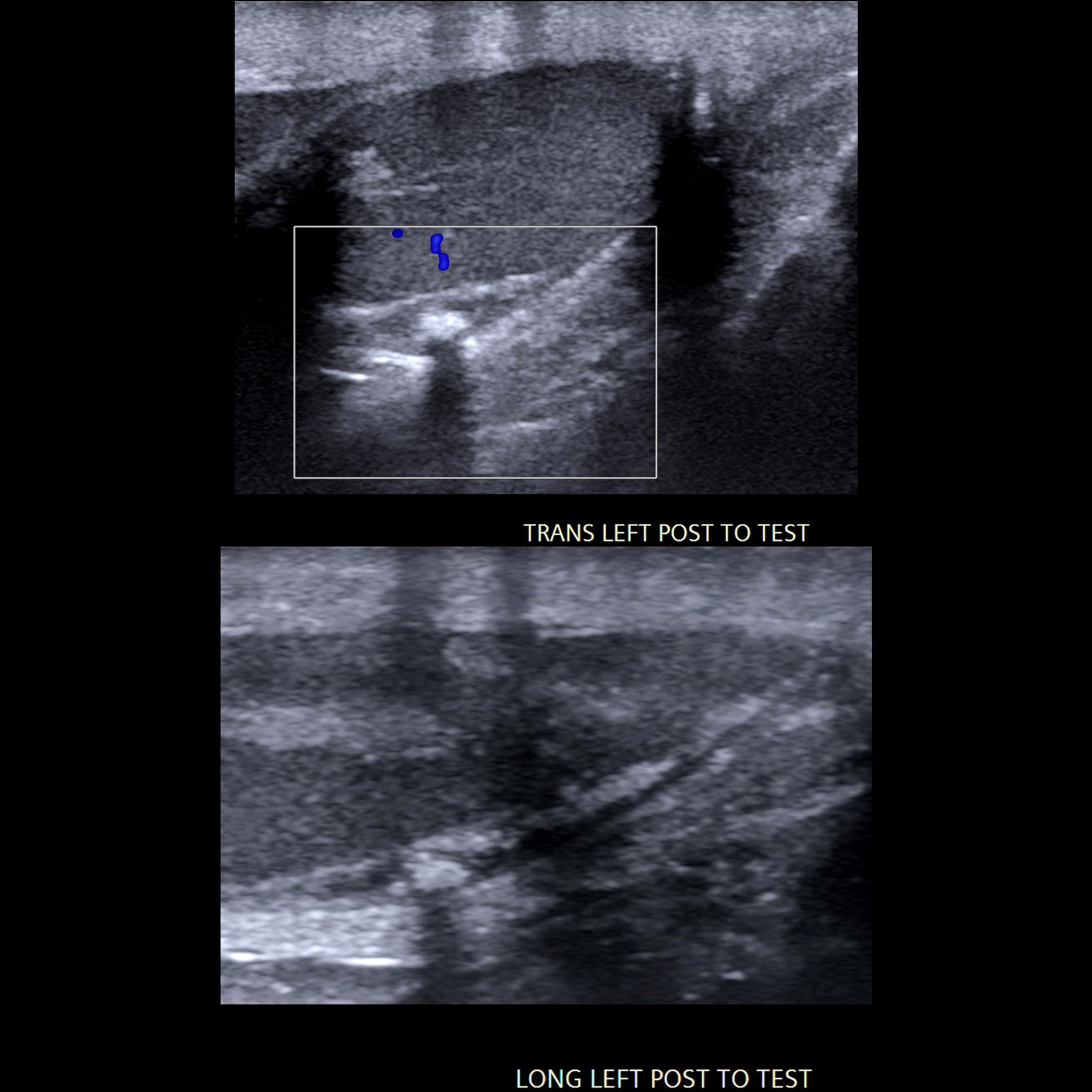 Pediatric Scrotolith | Pediatric Radiology Reference Article ...
