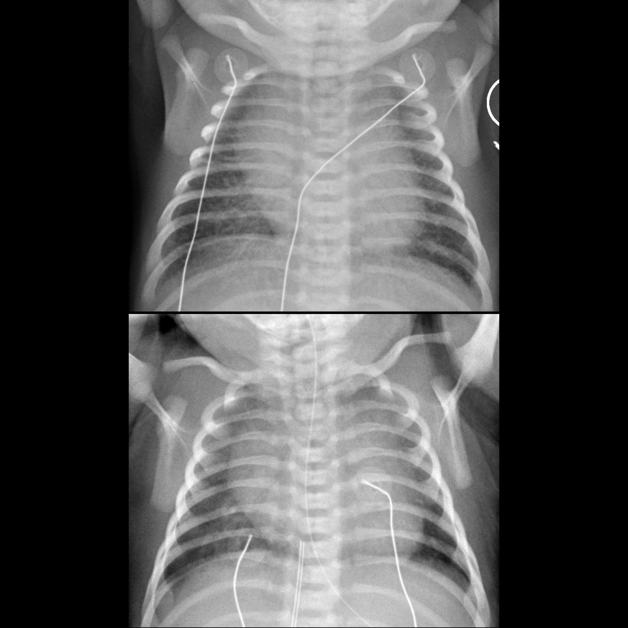 Transient Tachypnea of Newborn | Pediatric Radiology Reference Article ...