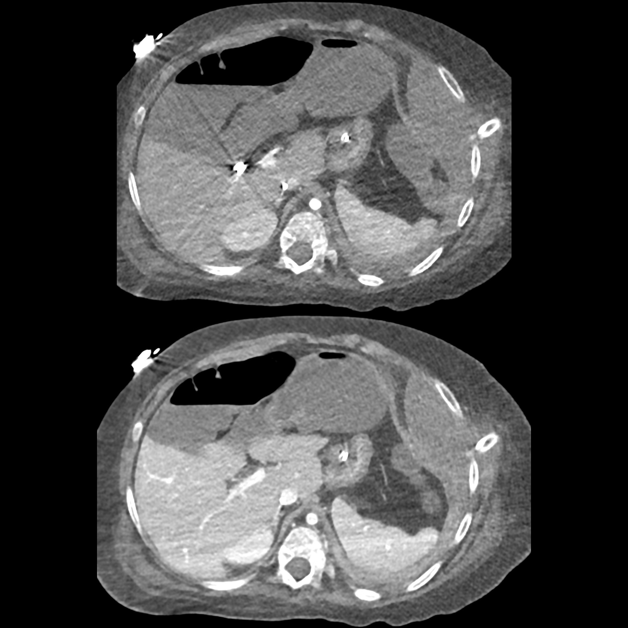 ChestTubeMalfunction08MDBloodyOutputFromChestTubeDecreastedHematocritAc ...