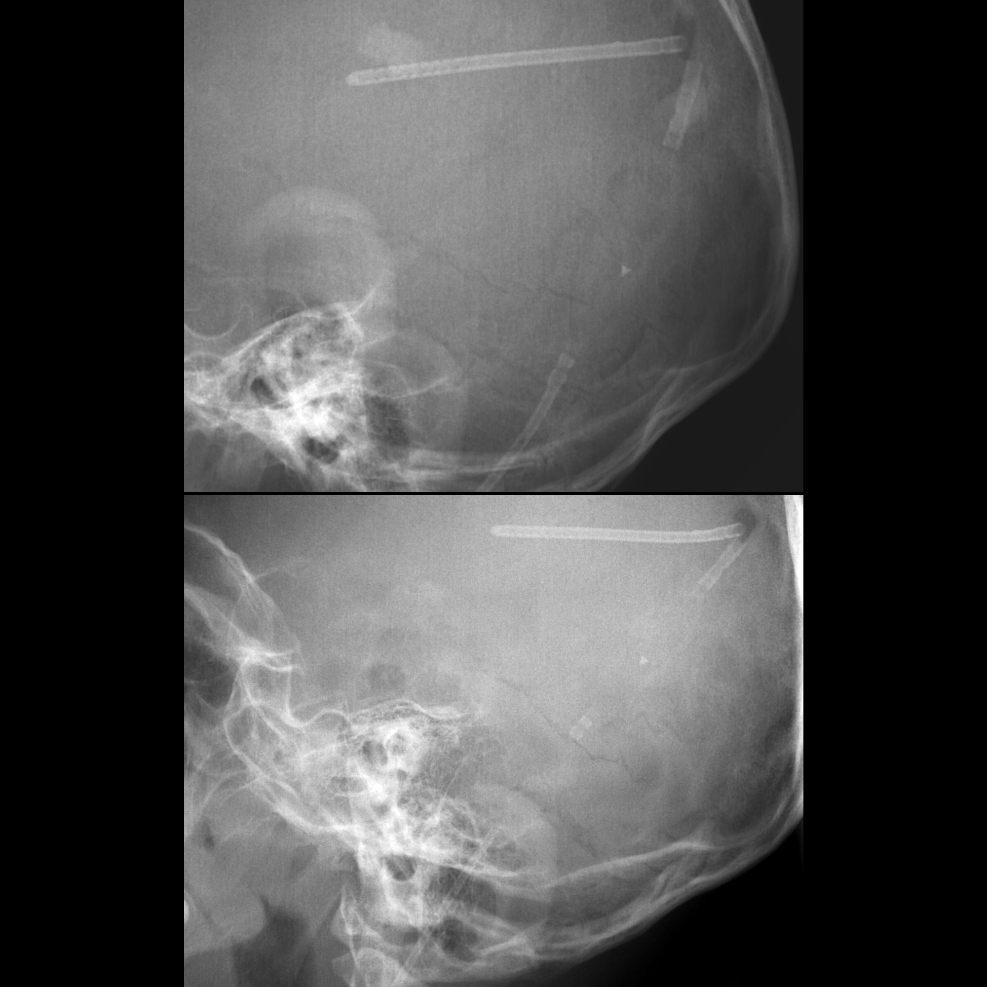 Pediatric Ventriculoperitoneal Shunt Malfunction / Malposition ...