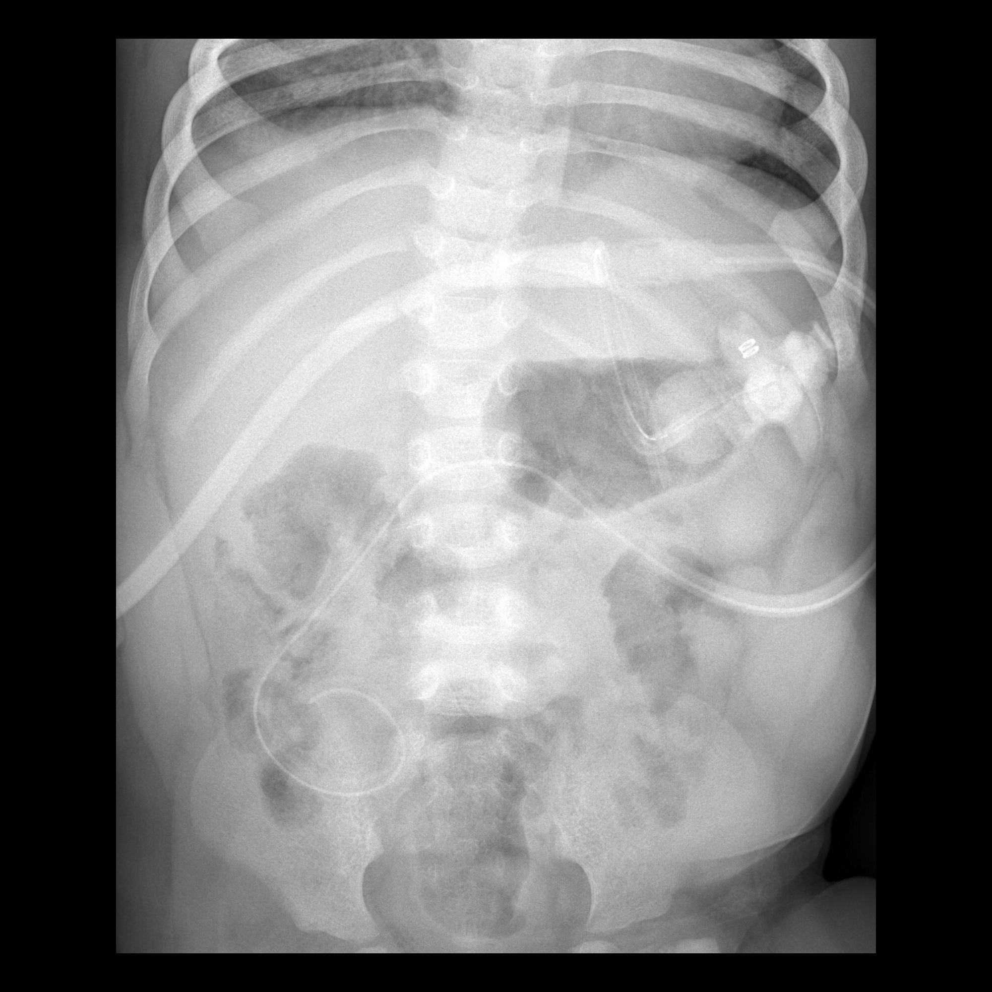 GastrostomyTubeMalfunction20MDGastrostomyJejunostomyVomitingWithFeedsMi ...