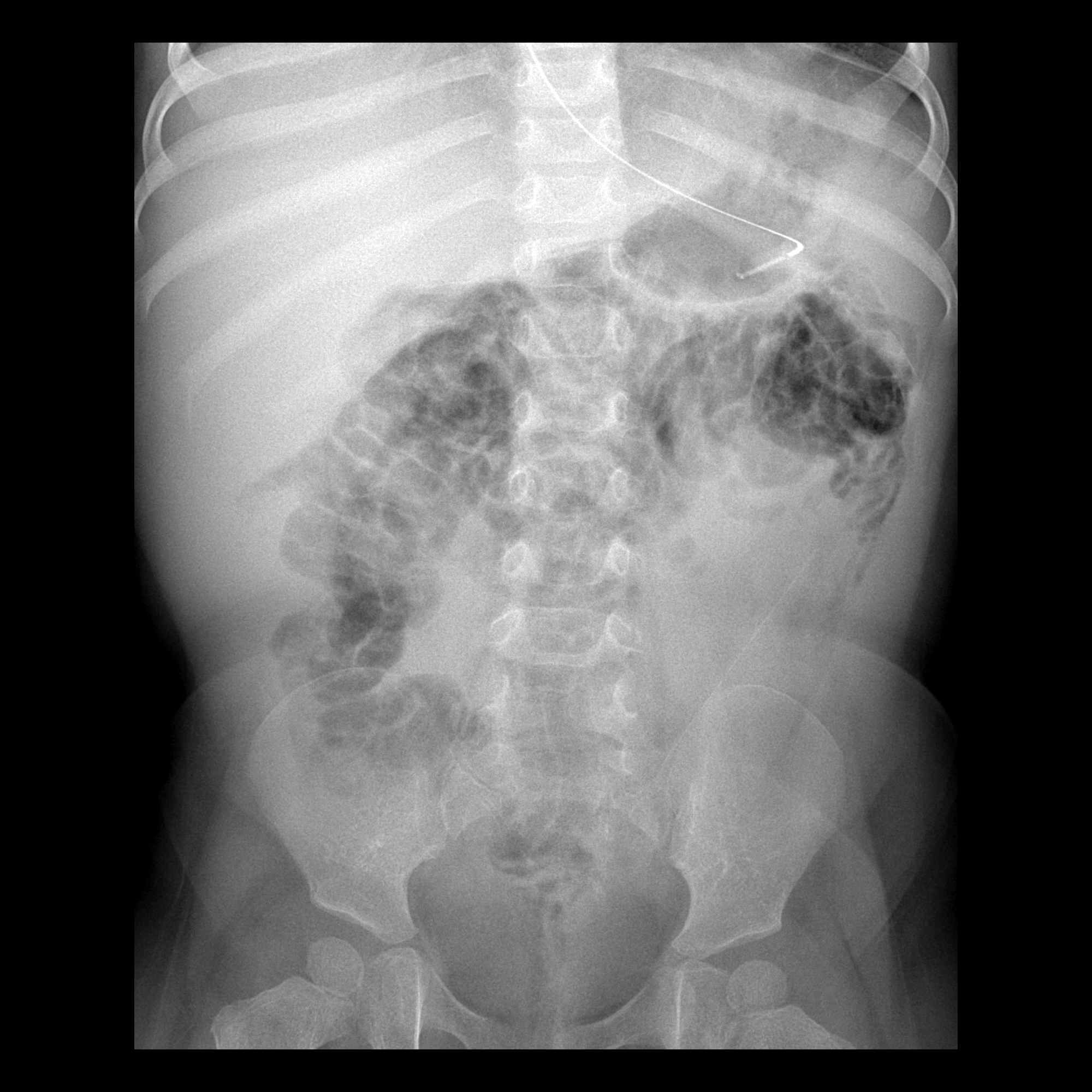 PneumatosisIntestinalis05MDAbdominalPainHemophagocyticLymphoHistiocytos ...