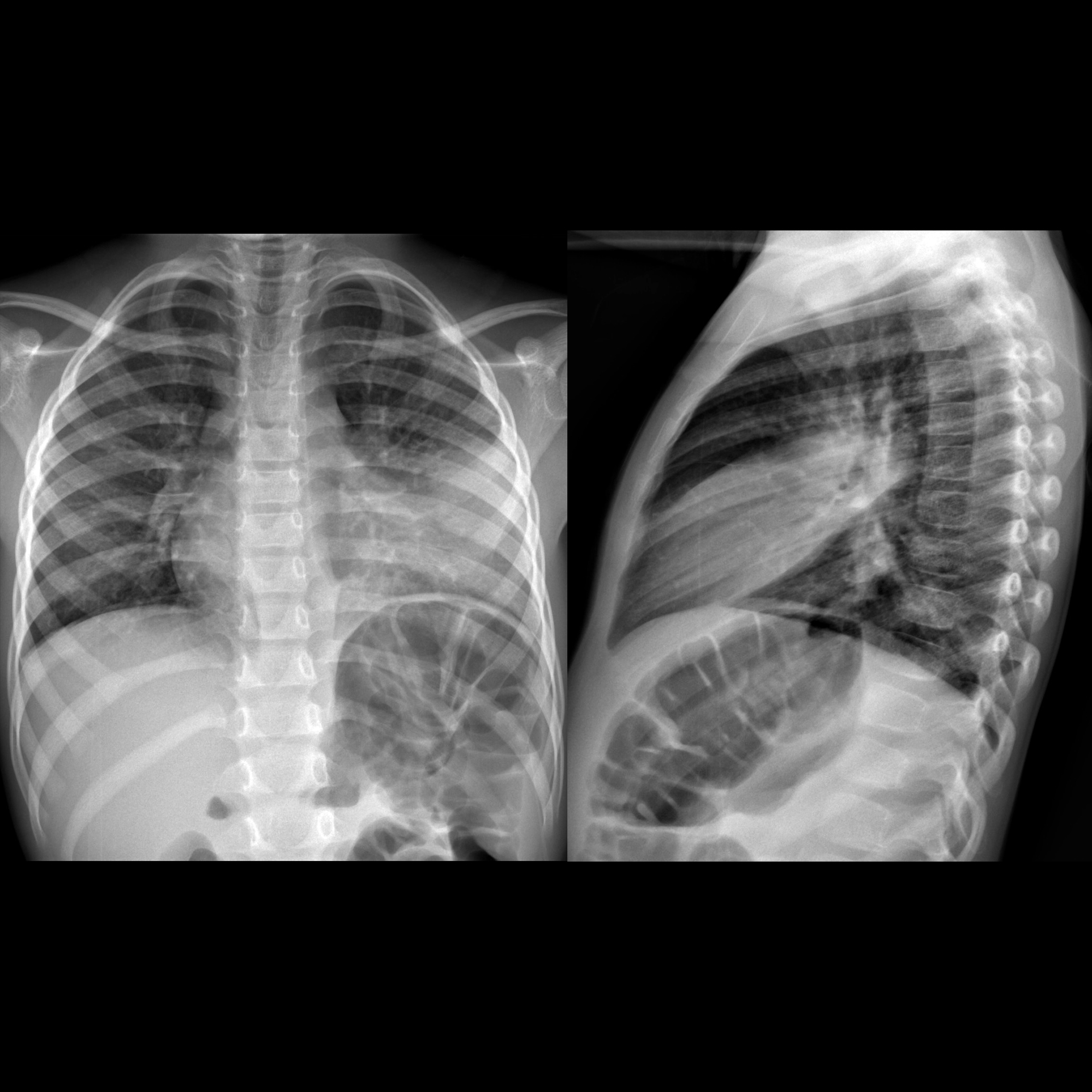 Pediatric Bacterial Pneumonia | Pediatric Radiology Reference Article ...