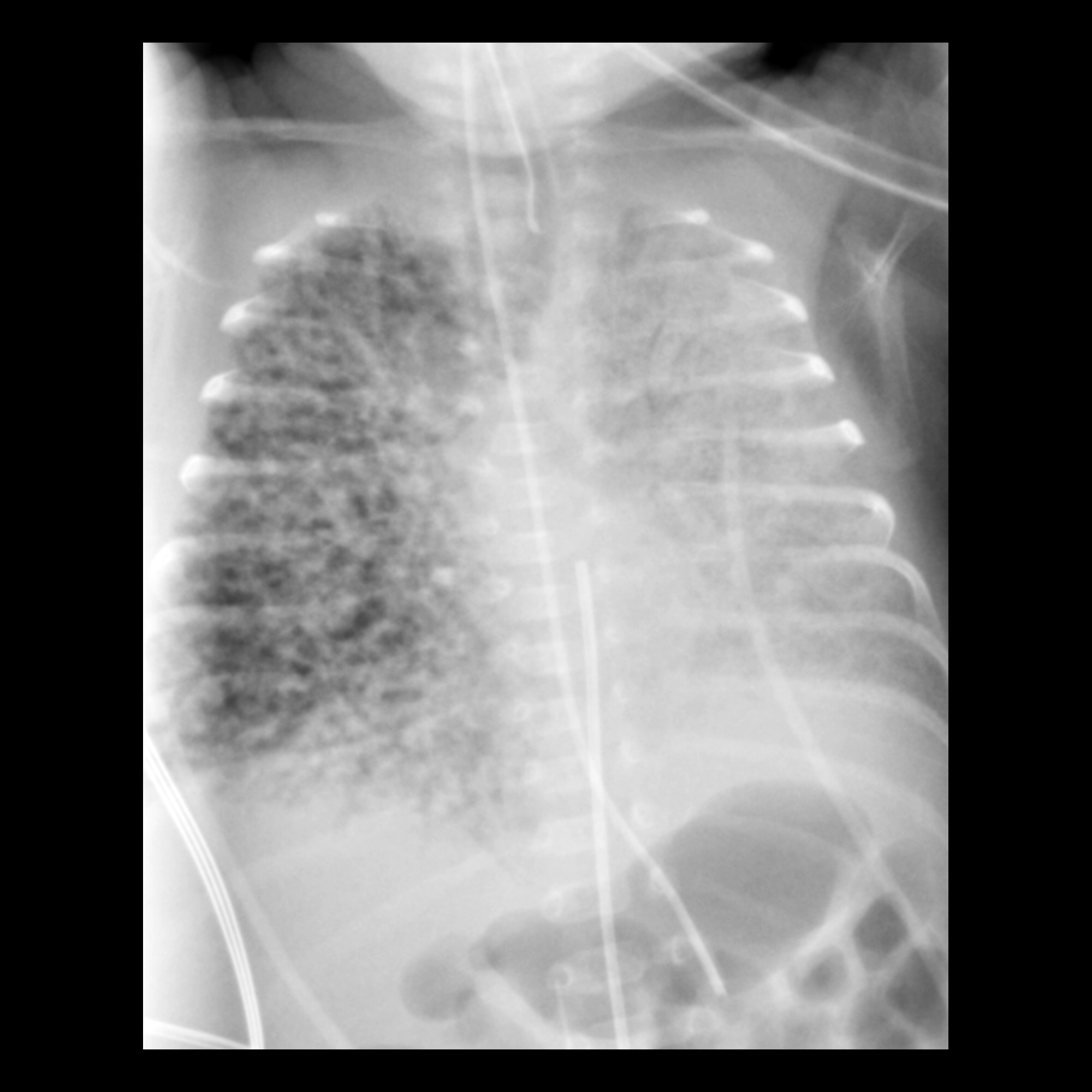 PulmonaryInterstitialEmphysema02MDPremieRightLungCXR13do | Pediatric ...