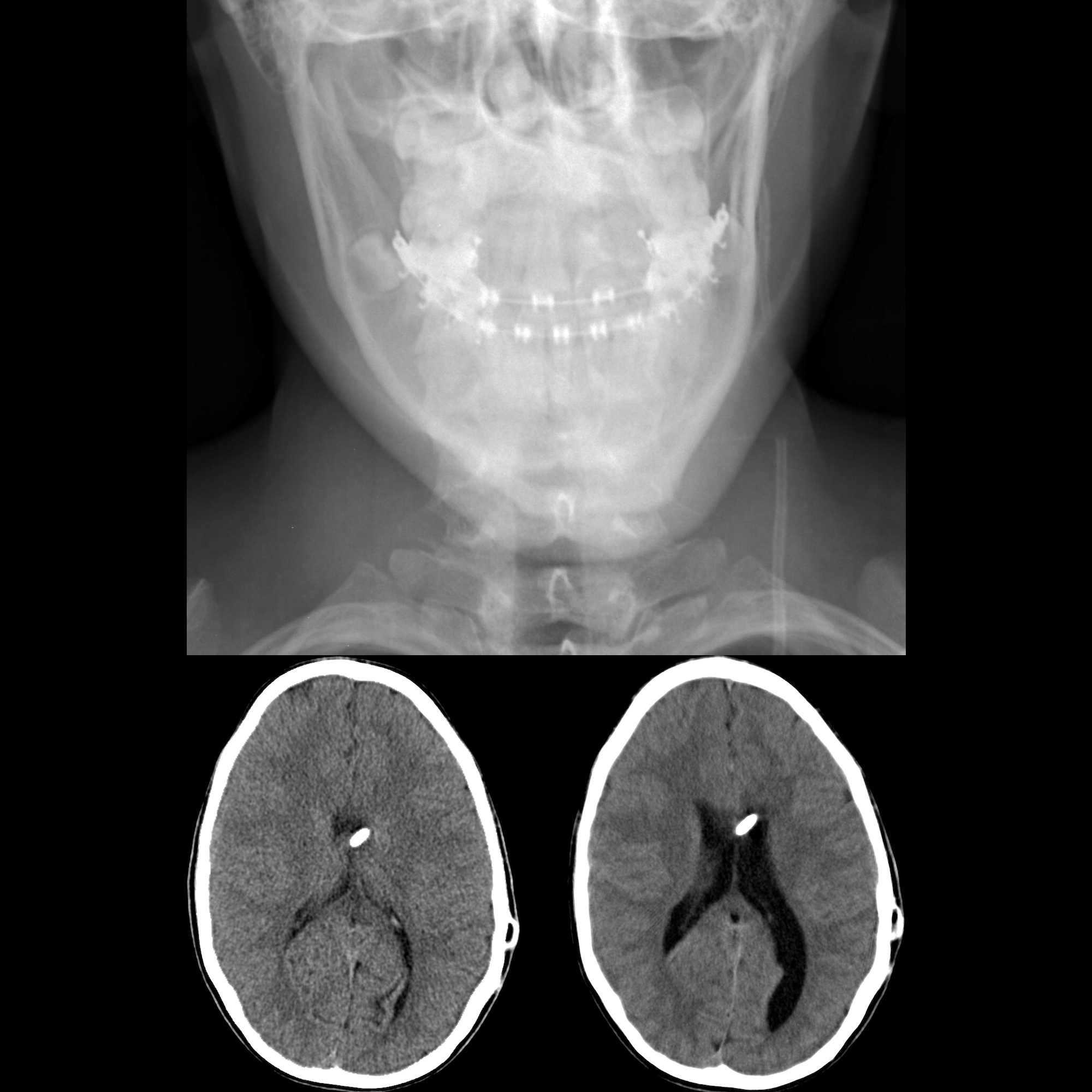 VentriculoPeritonealShuntMalfunction25MDHeadachesTubingBrokenInNeckPlnC ...