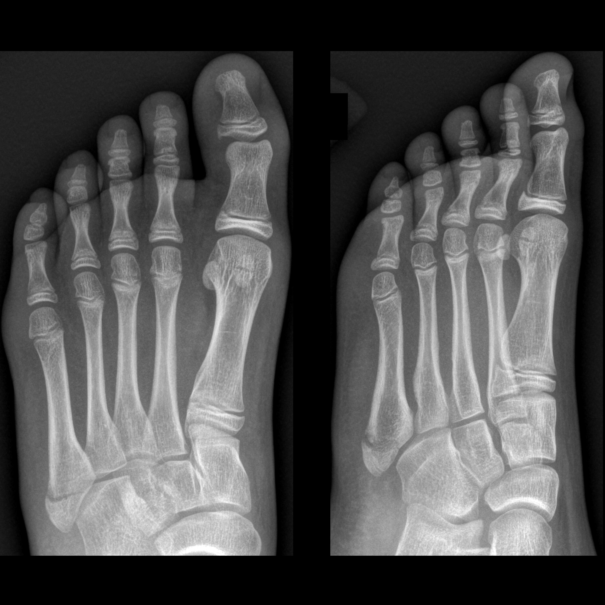 Pediatric Fifth Metatarsal Fracture | Pediatric Radiology Reference ...