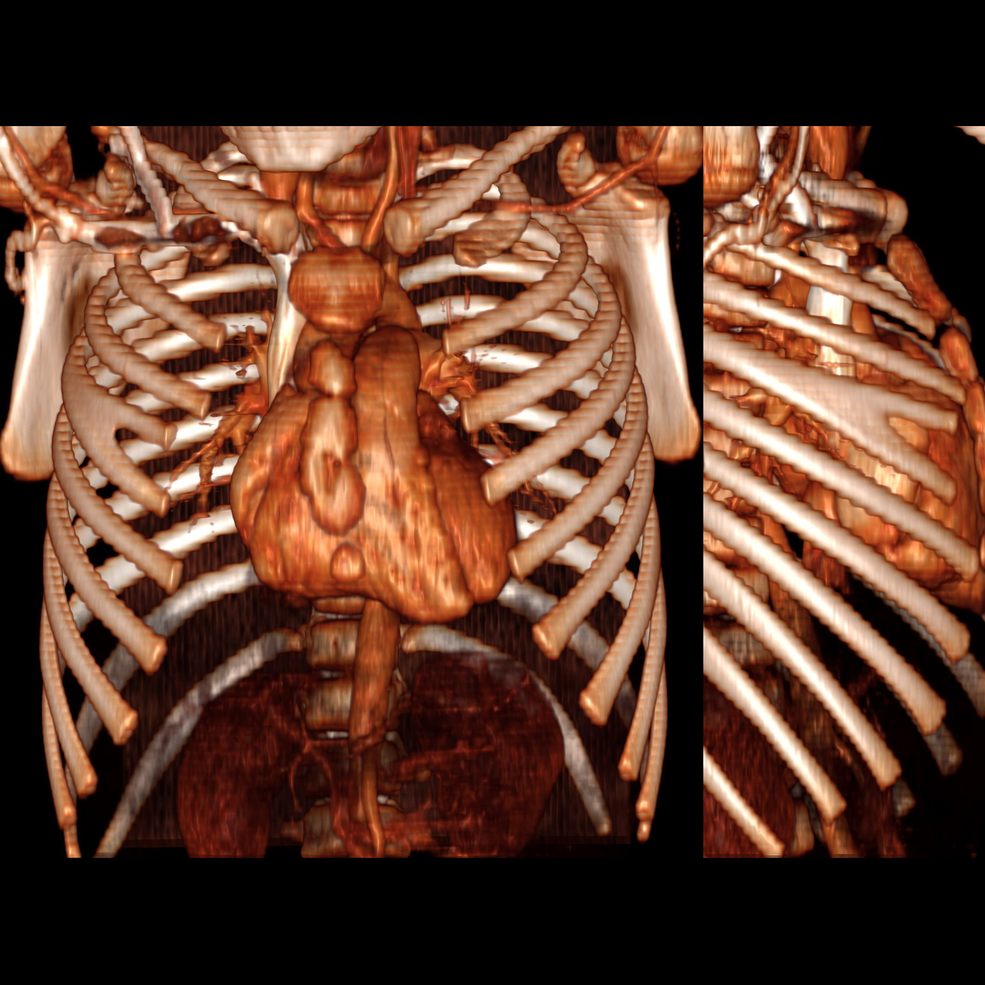 Pediatric Bifid Rib | Pediatric Radiology Reference Article | Pediatric ...