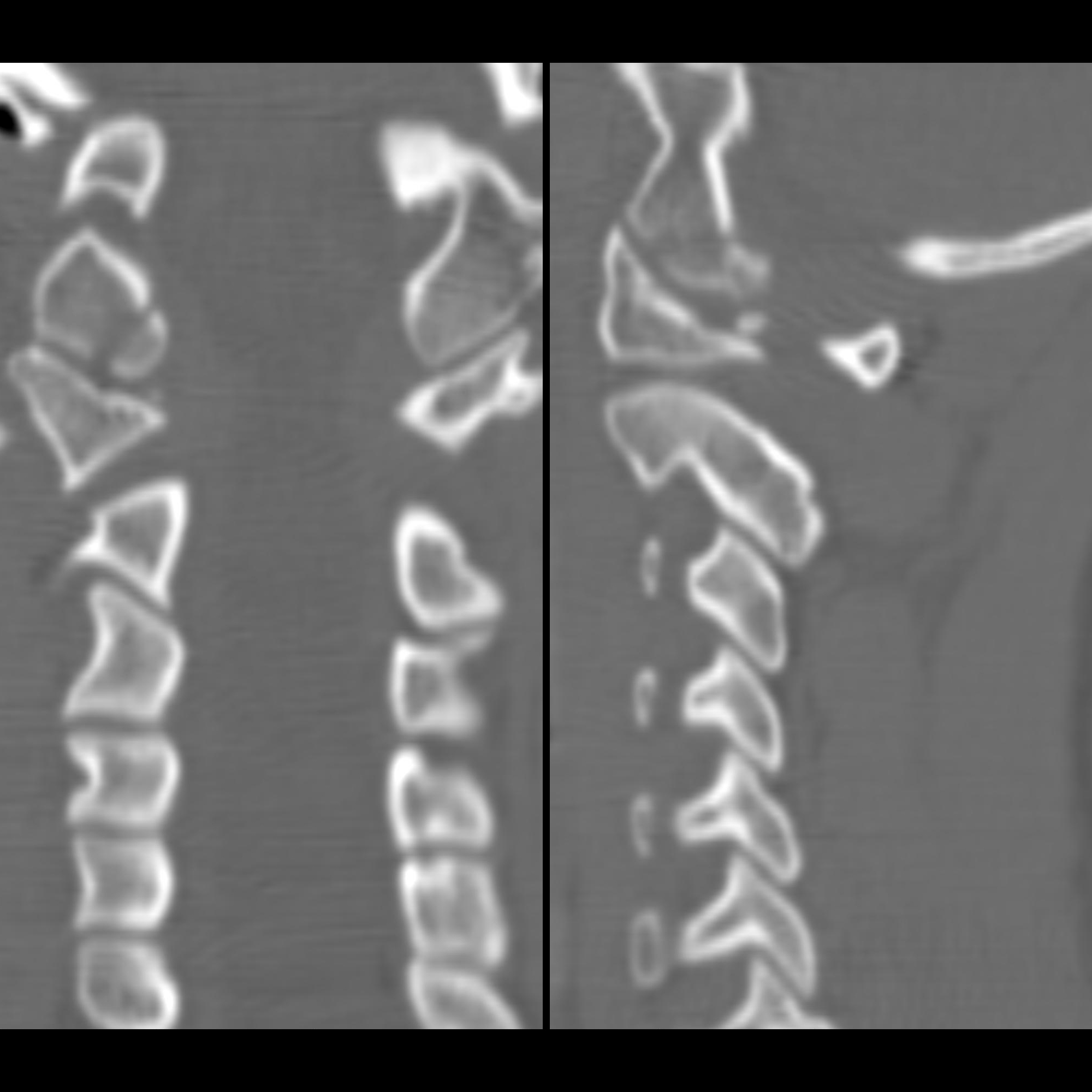 FractureOccipitalCondyle01MDRightMVACT13yo | Pediatric Radiology Case ...